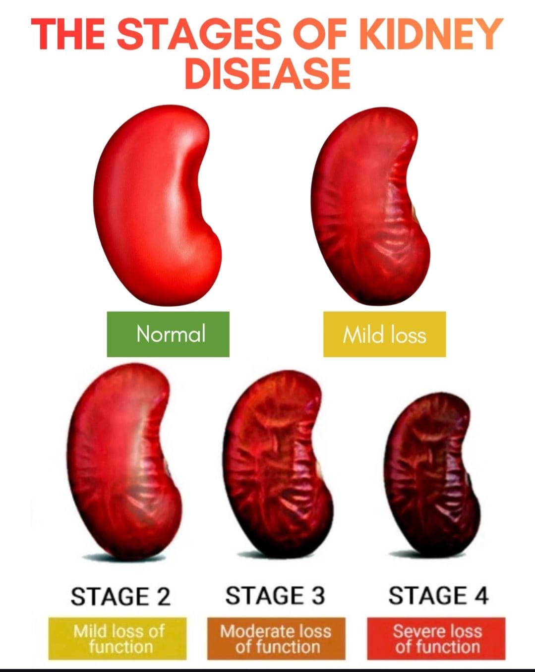 The 5 Stages of Kidney Disease - Remote Patient Monitoring with proRithm